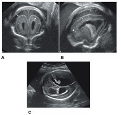 Ecografia Microcefalia