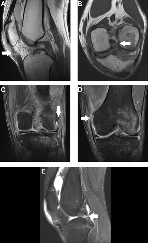 Multiple knee ligament tear: Magnetic Resonance imaging diagnosis