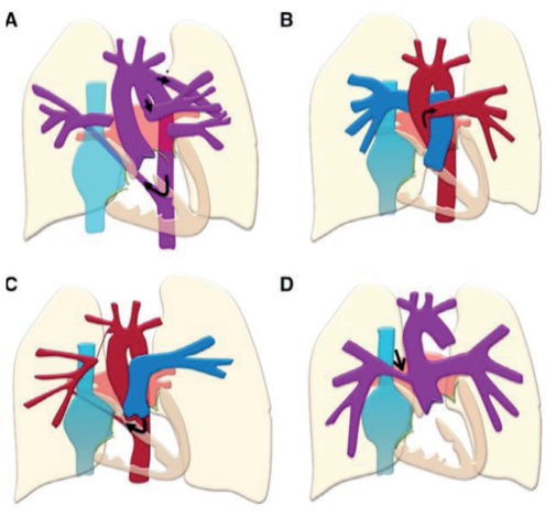 Hipertensión pulmonar en cardiopatías congénitas del adulto
